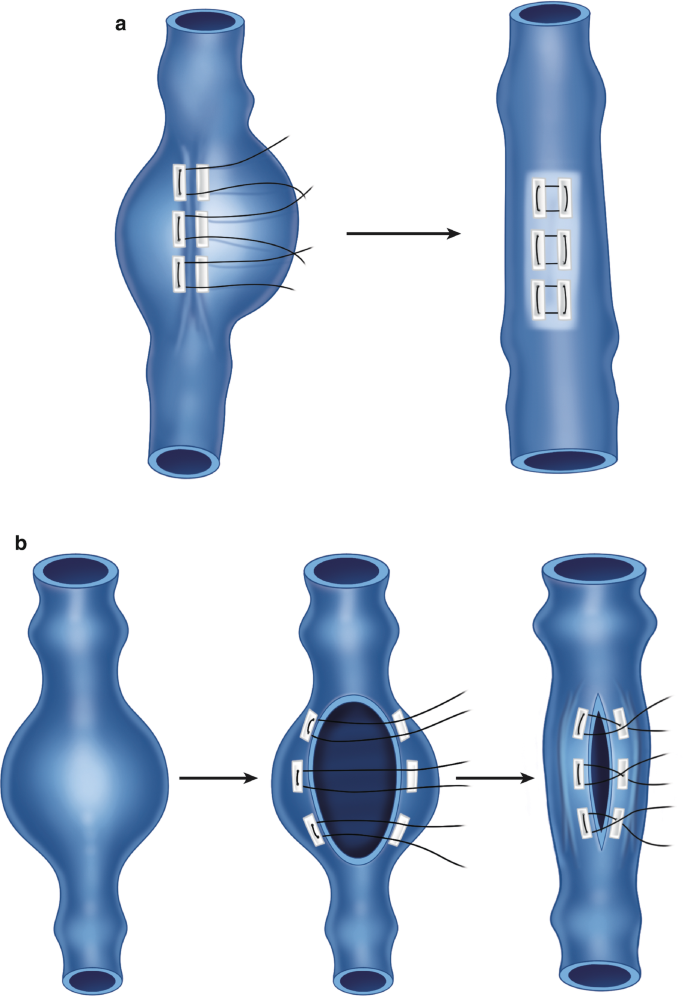 Popliteal Venous Aneurysm | SpringerLink