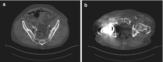 Management of Femoral Artery Pseudoaneurysm with AV Fistula | Springer ...