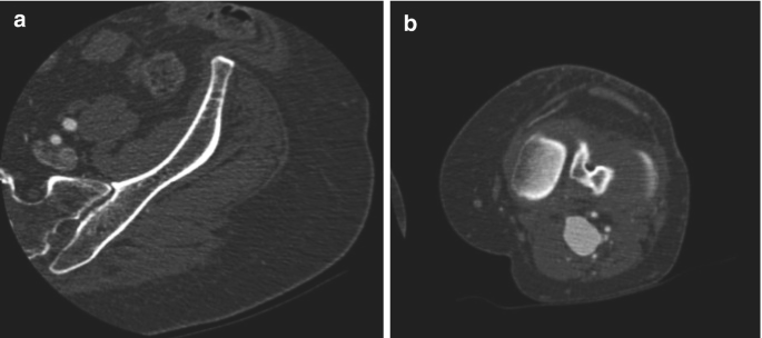 Popliteal Artery and Venous Pseudoaneurysm with Arteriovenous Fistula ...
