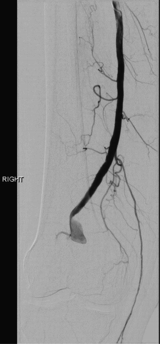 Catheter-Based Arteriography for Evaluation of the Lower Extremity ...