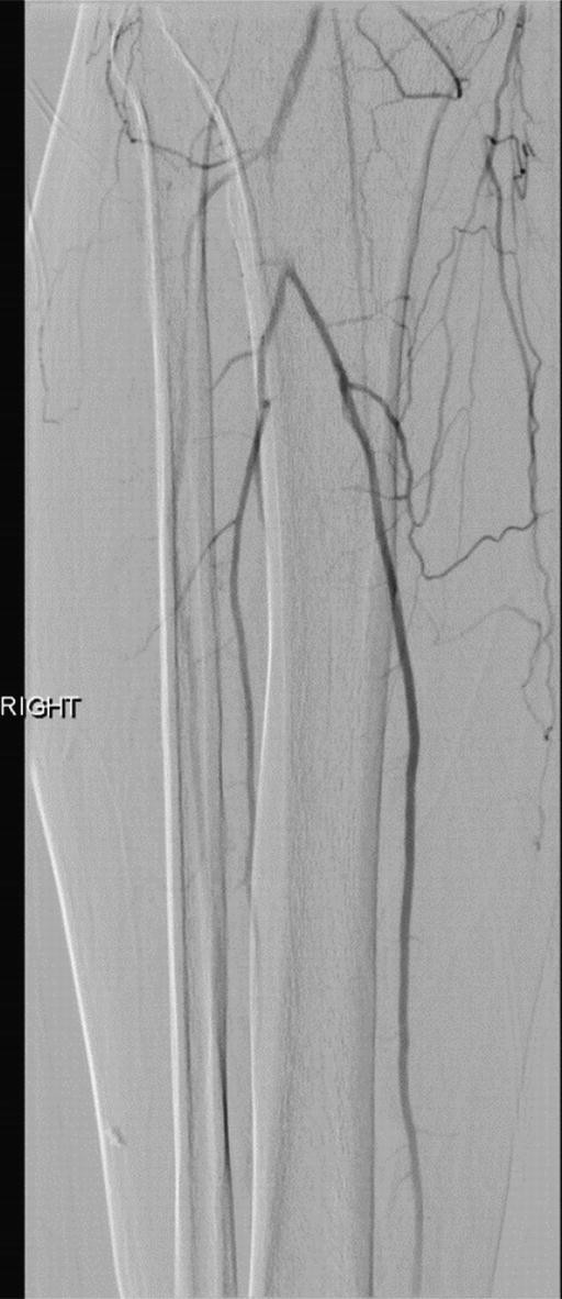 Catheter-Based Arteriography for Evaluation of the Lower Extremity ...