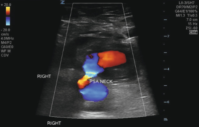 Femoral Artery Pseudoaneurysm Secondary to Femoral Artery Intervention ...