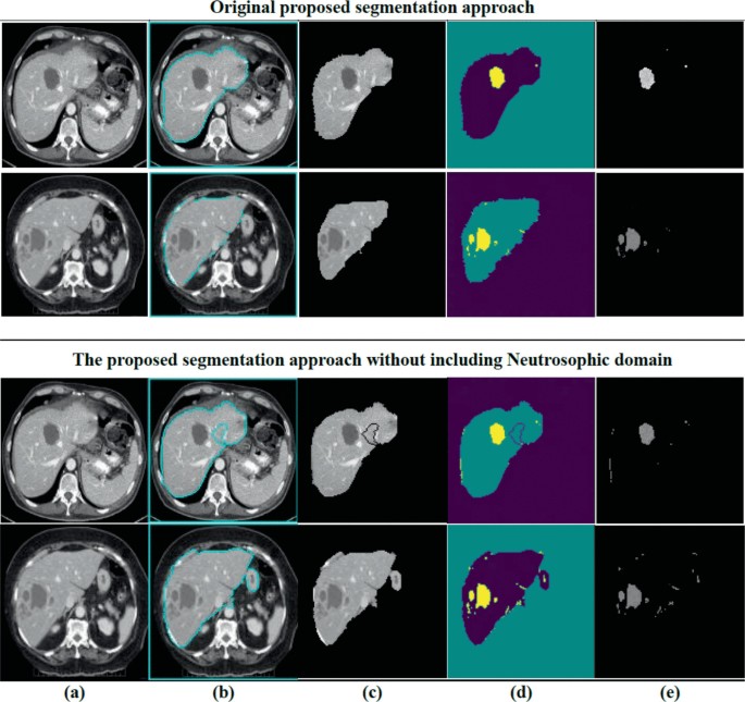 Development of Hybrid Segmentation Technique for Liver Tumor Detection ...