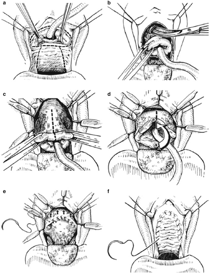 Transvaginal Bladder Neck Closure | SpringerLink