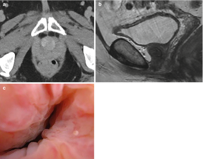 Periurethral Bulking Agent Injection | SpringerLink