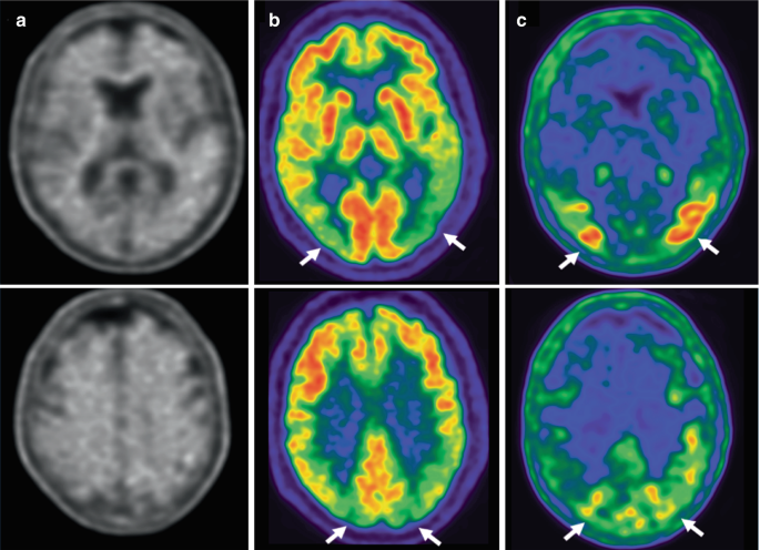 Case 2: Alzheimer’s Disease: [18F]FDG, Tau, and Amyloid PET | Springer ...
