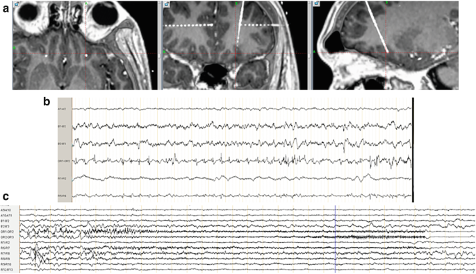 Case 26: Focal Refractory Epilepsy with Negative MRI | SpringerLink