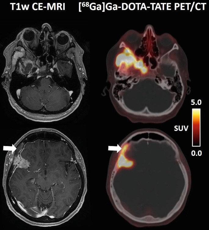 Case 36: Meningioma with Difficult Delineation on MRI | Springer Nature ...