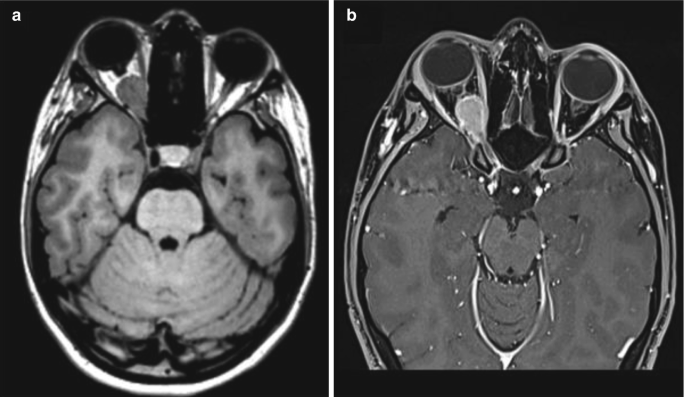 Case 37: Optic Nerve Sheath Meningioma (ONSM) | Springer Nature Link