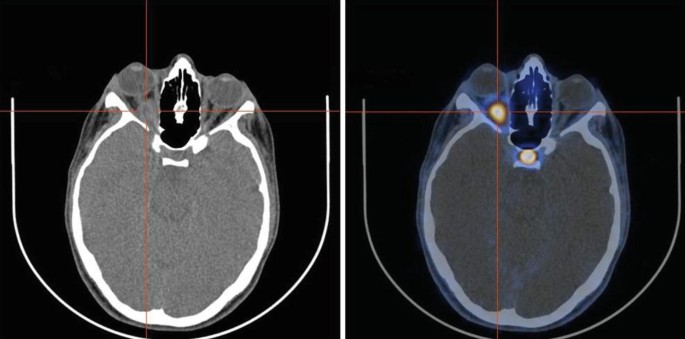 Case 37: Optic Nerve Sheath Meningioma (ONSM) | Springer Nature Link