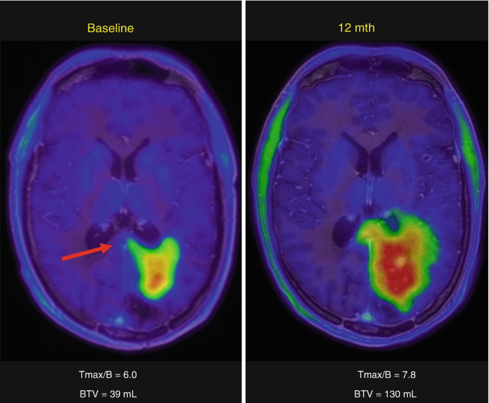 Case 39: Progressive Glioma | Springer Nature Link