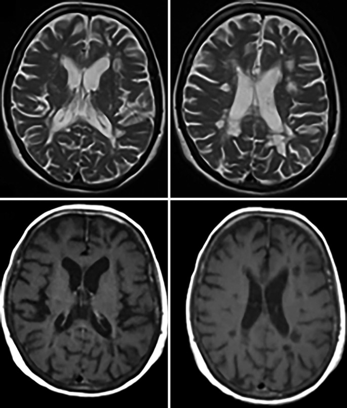 Case 51: Tumefactive Multiple Sclerosis Lesions (TMS) | Springer Nature ...