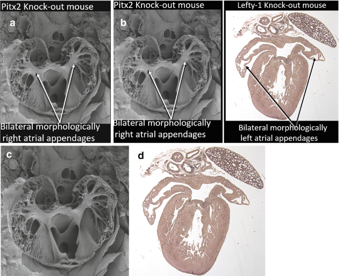 Isomerism of the Atrial Appendages (Formerly Heterotaxy) | Springer ...