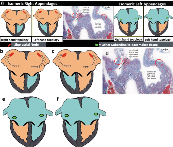 Isomerism of the Atrial Appendages (Formerly Heterotaxy) | Springer ...