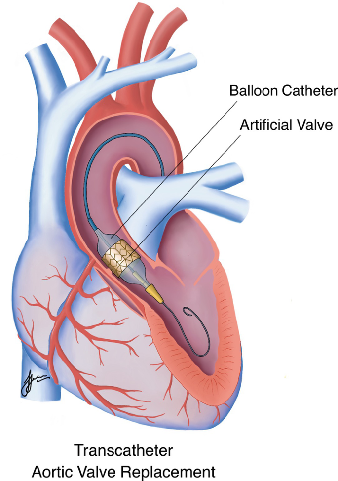 Repair and Replacement of Malfunctioning Valves: Surgery, TAVR, and ...