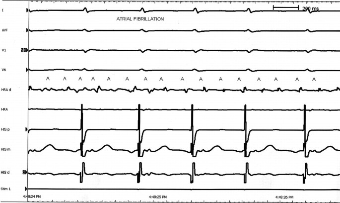 Atrial Fibrillation and Atrial Flutter | Springer Nature Link