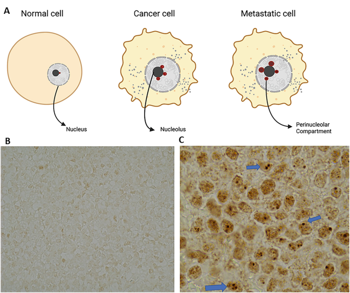 The Perinucleolar Compartment: A Promising Target to Prevent Cancer ...