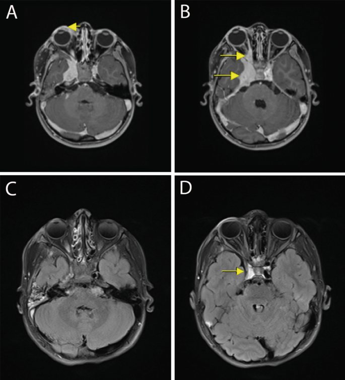 Squamous Cell Carcinoma in Children | SpringerLink