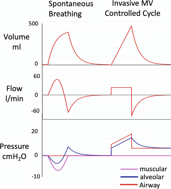 Principles of Mechanical Ventilation | Springer Nature Link