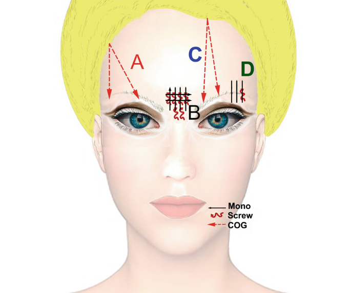 Transcutaneous Suture Lifts: Eyebrows | SpringerLink