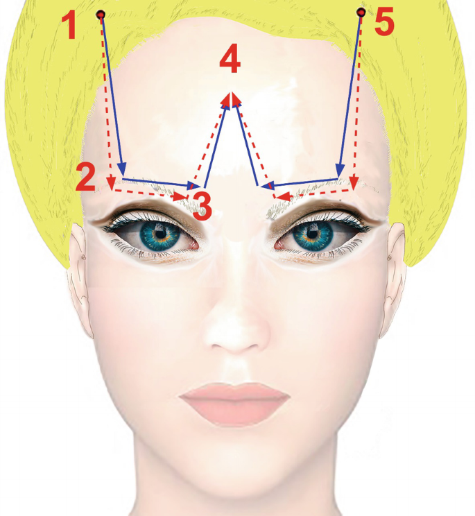 Transcutaneous Suture Lifts: Eyebrows | Springer Nature Link