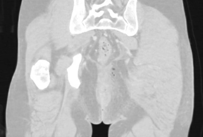 Rectal Injury | Springer Nature Link (formerly SpringerLink)