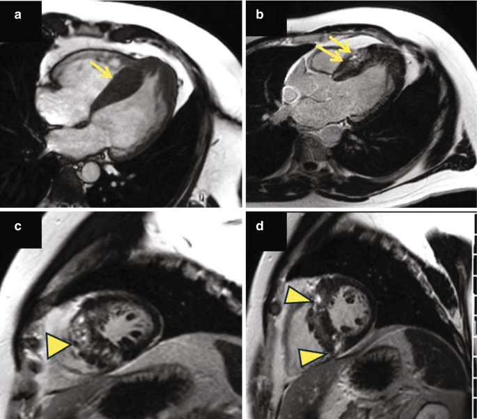 Role of Cardiovascular Magnetic Resonance in Hypertrophic ...