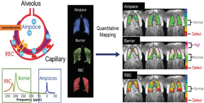 Hyperpolarized Xenon MRI: Technique and Applications | Springer Nature Link