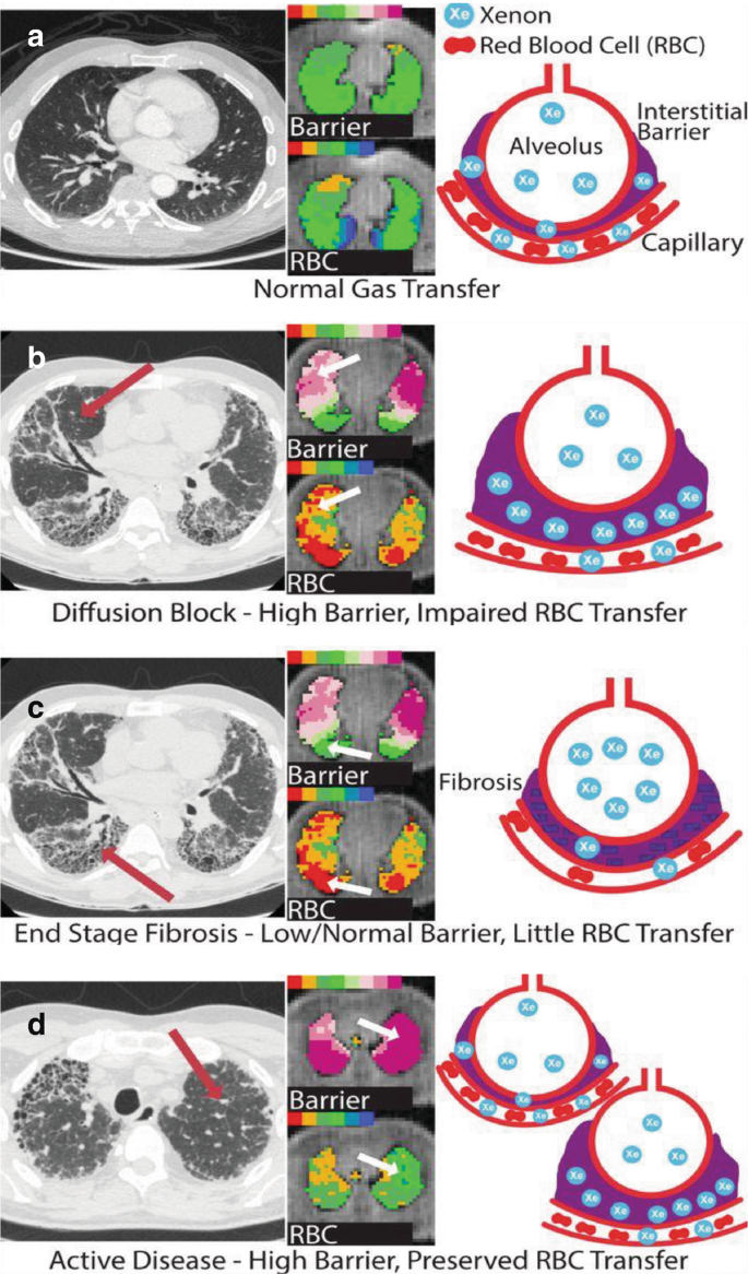 Hyperpolarized Xenon MRI: Technique and Applications | Springer Nature Link