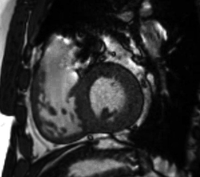 Cardiac MRI in Adults with Congenital Heart Disease: A Case Based ...
