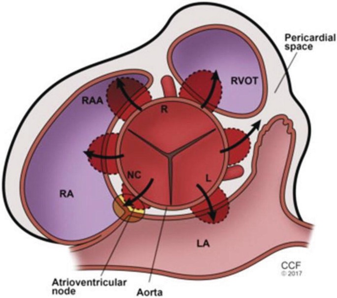 Echocardiography and Diseases of the Aorta | Springer Nature Link ...