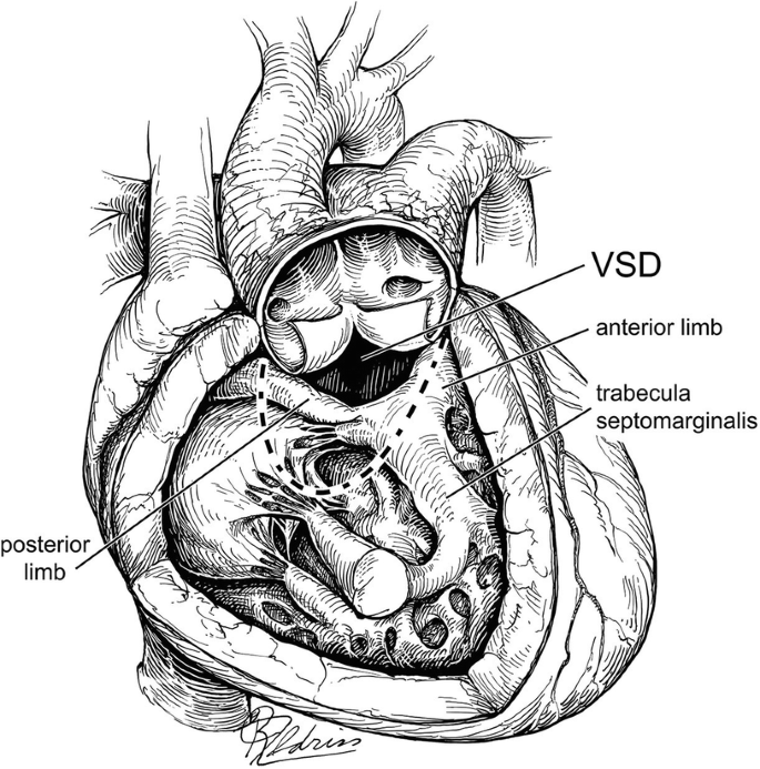 Complications Associated with Repair of Common Arterial Trunk ...