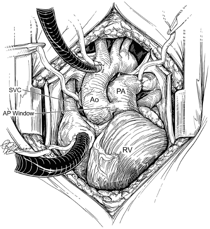 Complications Associated with Repair of Aortopulmonary Window ...
