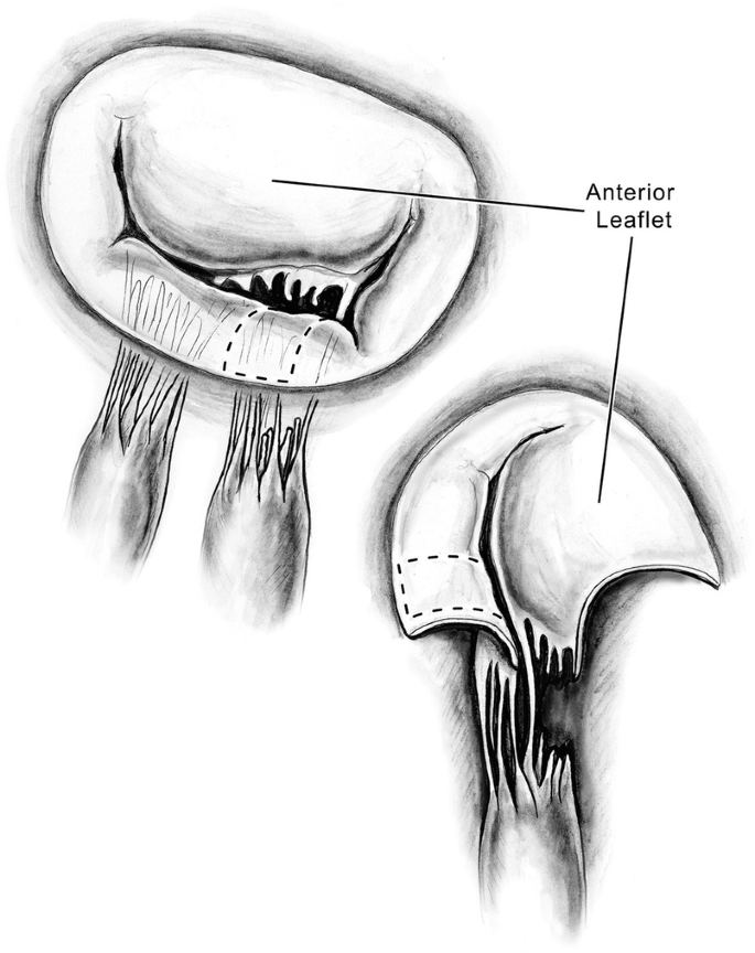 Complications Associated with Mitral Valve Surgery for Congenital ...