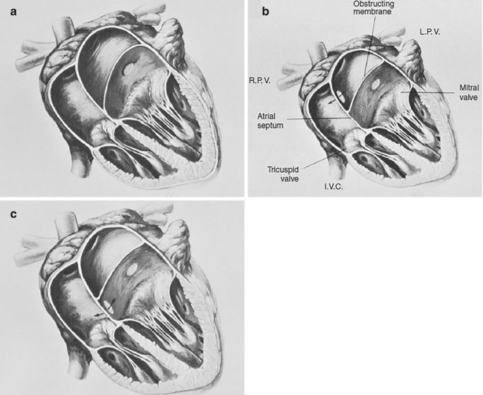 Complications Associated with Repair of Cor Triatriatum | Springer ...
