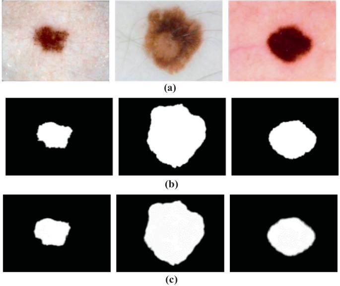 ResAttU-Net: Enhancing Skin Lesion Segmentation with a Hybrid Deep ...