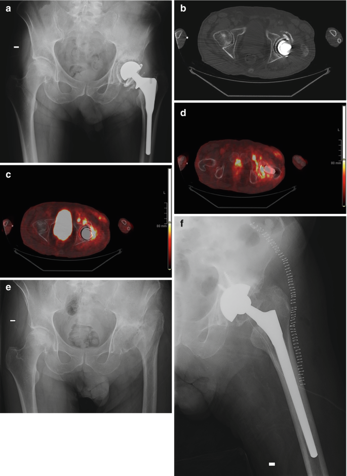 Revision Total Hip Arthroplasty for Periprosthetic Joint Infection ...