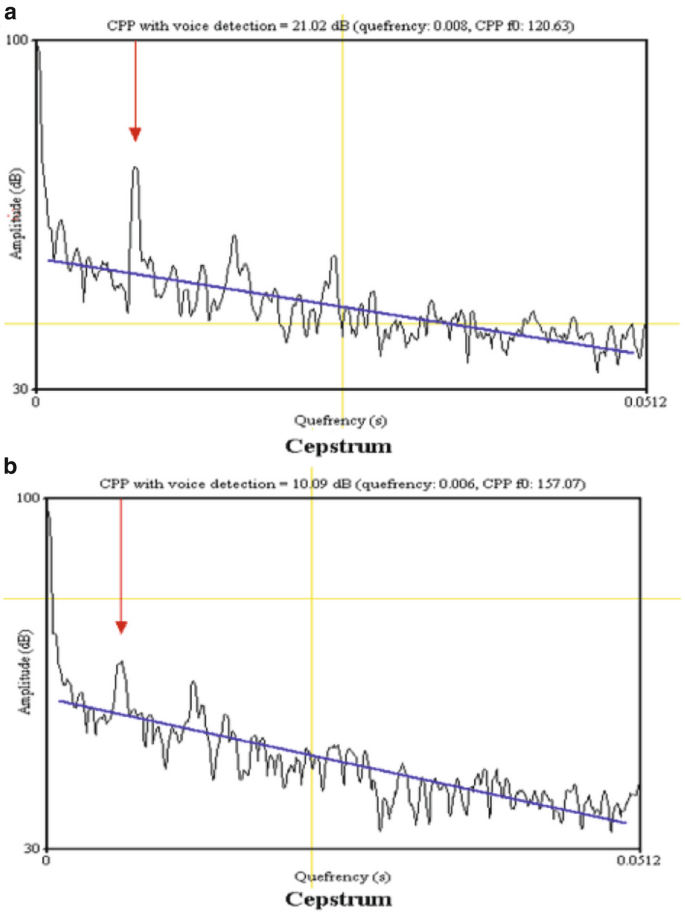 Pathology of Voice-Related Biomarkers in Laryngology | Springer Nature Link