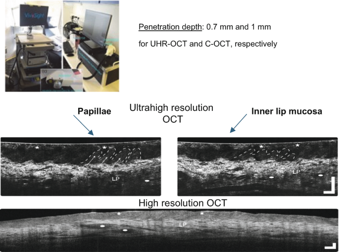 Optical Coherence Tomography and Voice-Related Biomarkers | Springer ...