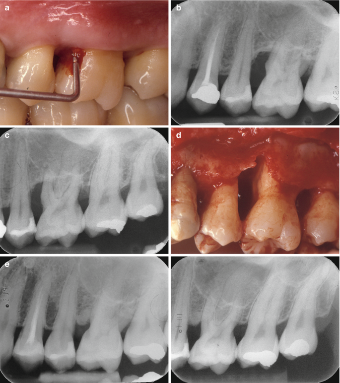 Evidence-Based Decision-Making in Periodontal Tooth Prognosis and ...