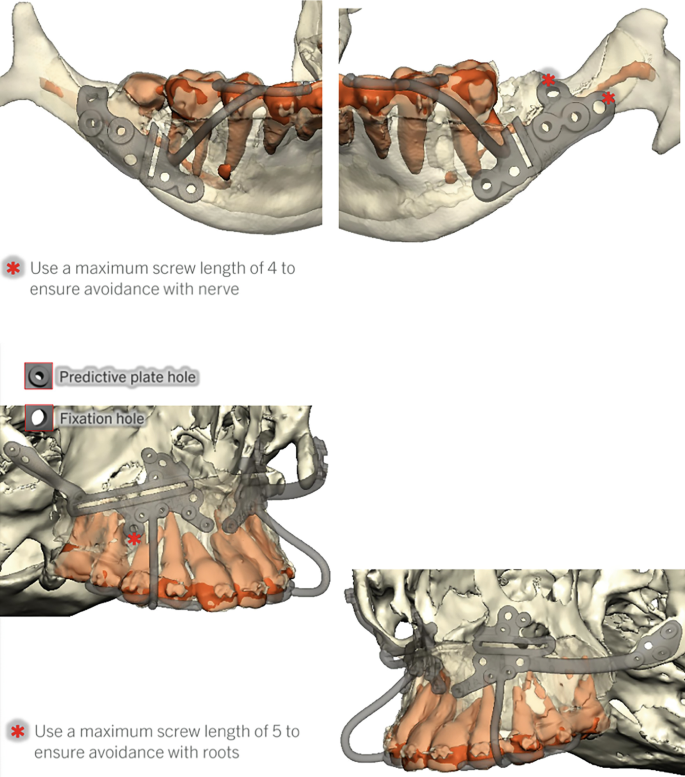 The Role of Custom Cutting Guides and Plates in Orthognathic Surgery ...