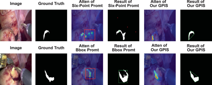 GPIS: Geometric Informed Polygon Prompt for Incision Segmentation | Springer Nature Link