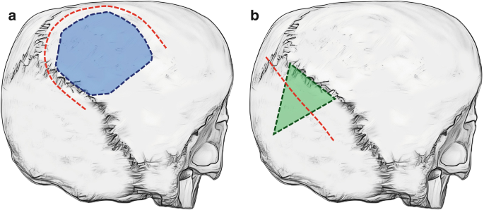 The Parietal and Occipital Approaches | SpringerLink