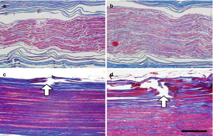 Nerve Compression Neuropathies of the Hand | Springer Nature Link