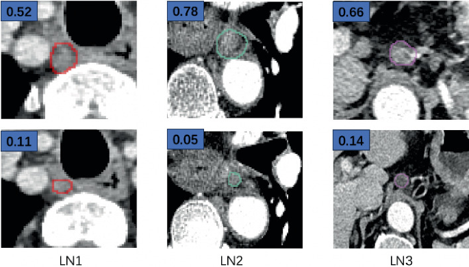 Lymph Node Metastasis Classification with Prototype-Guided Multiple ...