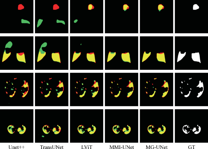 MG-UNet: A Memory-Guided UNet for Lesion Segmentation in Chest Images ...