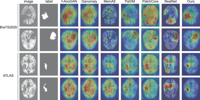 StyleGAN-Based Brain MRI Anomaly Detection via Latent Code Retrieval ...