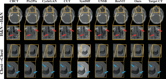 Anatomy-Conserving Unpaired CBCT-to-CT Translation via Schrödinger ...