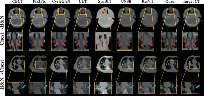 Anatomy-Conserving Unpaired CBCT-to-CT Translation via Schrödinger ...