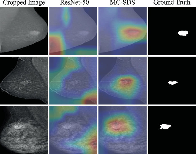 Domain Generalization for Mammogram Classification by Suppressing ...